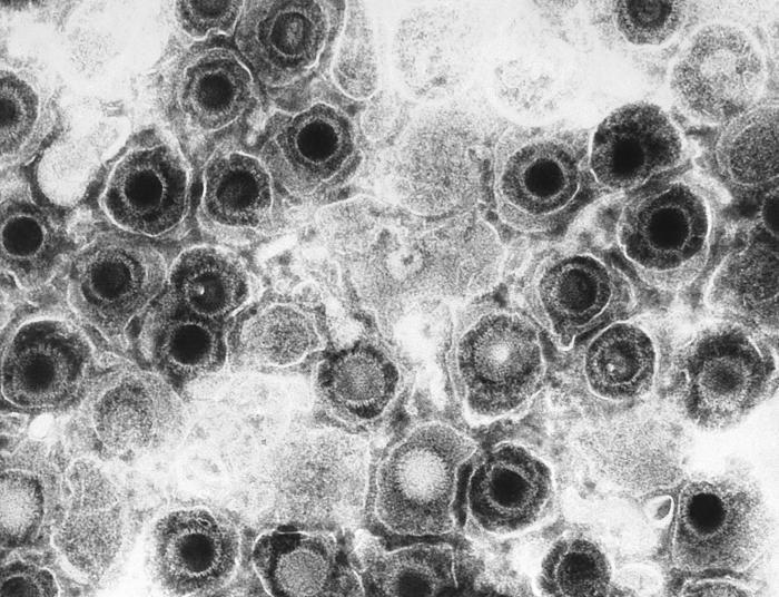 Neonatal HSV infections may lead to long-term cognitive impairment ...