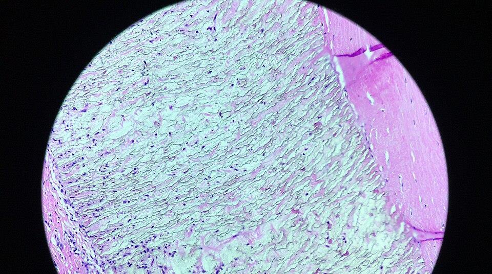 Complexity key to preventing infection after heart surgery | News | The ...