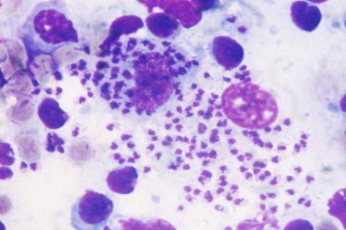 Test detects co-infection by novel parasite in severe cases of visceral ...