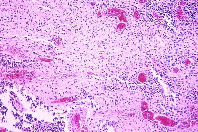 New typhoid conjugate vaccine Bio-TCV® approved in Indonesia | News ...