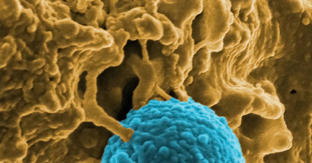 Dangerous surgical site infections can be reduced with simple ...