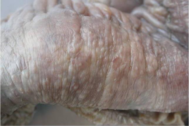 tubercle tuberculosis