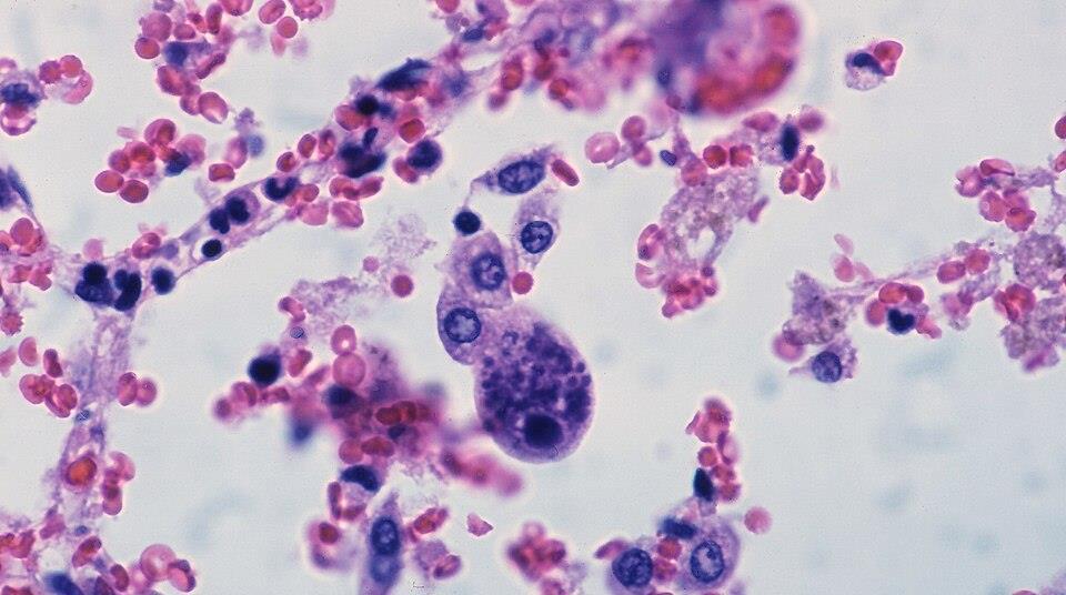New study finds dried blood spot test reliably detects congenital CMV ...