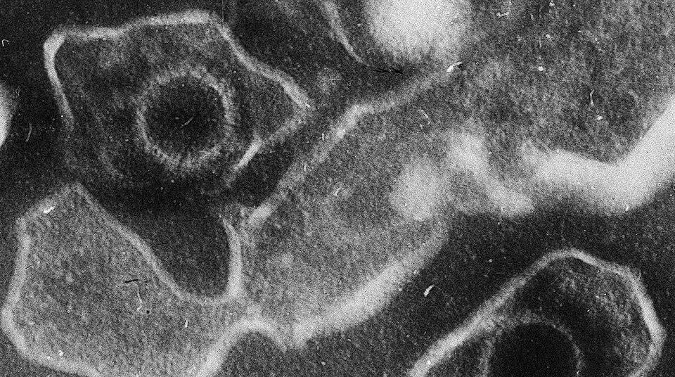 New mechanism links Epstein-Barr virus to MS | News | The Microbiologist