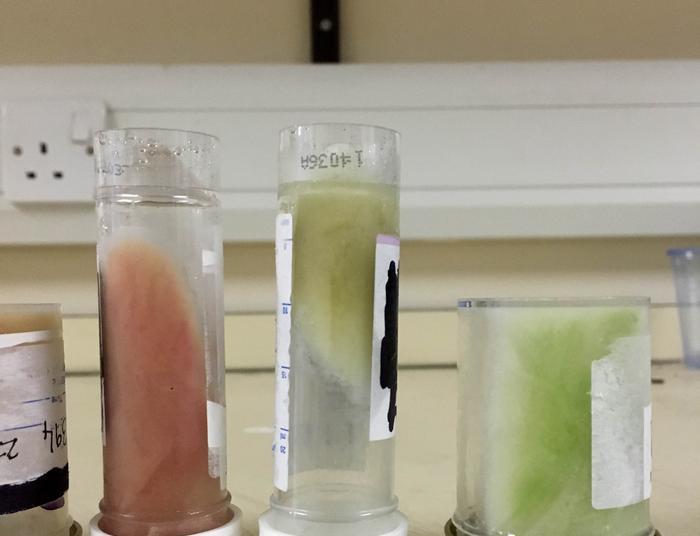 bronchiectasis sputum sample