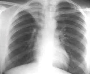 M42 announces breakthrough results for its AI-powered tuberculosis ...