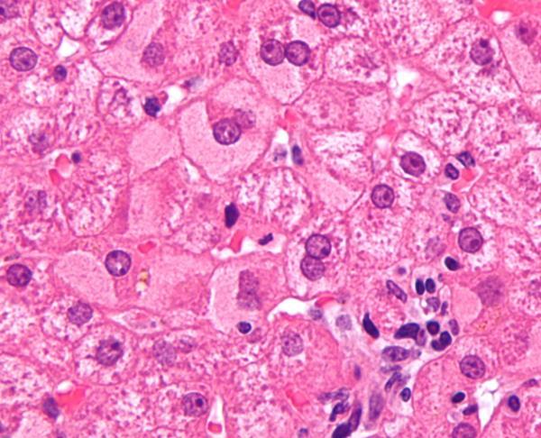 Under the microscope: viral hepatitis | Features | The Microbiologist