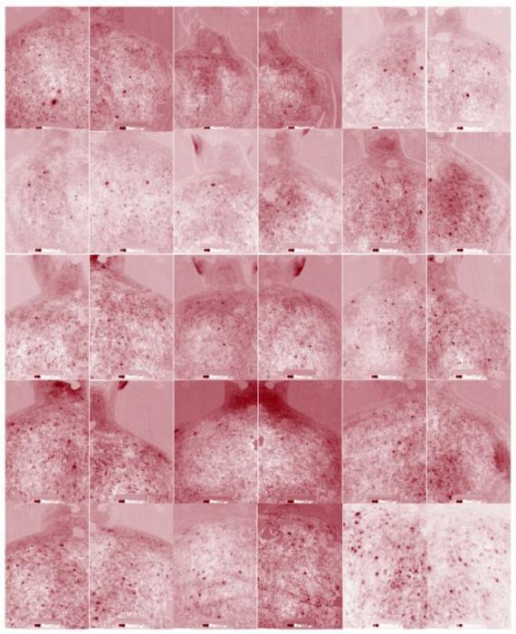 Insights for future research and practical approaches in truncal acne ...