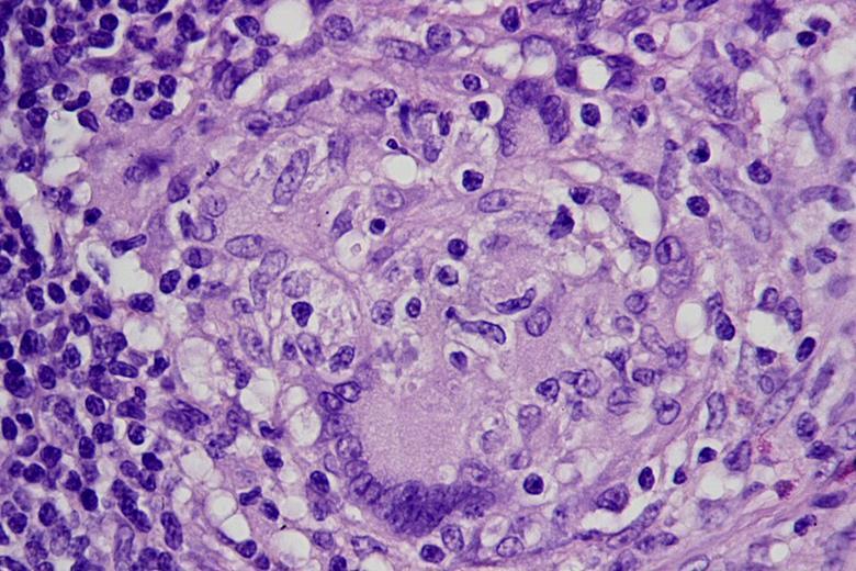 Gut bacteria changes at the earliest stages of inflammatory bowel ...