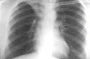 M42 announces breakthrough results for its AI-powered tuberculosis ...